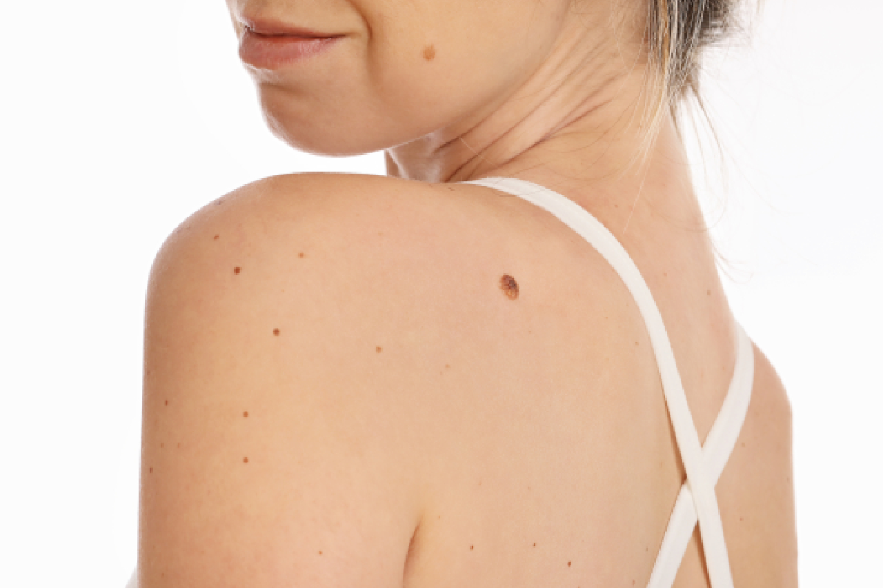 Common Bumps on the skin - Synergy Clinic